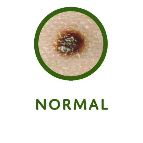 How to Check Your Moles for Skin Cancer - Prevent Cancer Foundation