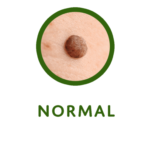 How to Check Your Moles for Skin Cancer - Prevent Cancer Foundation