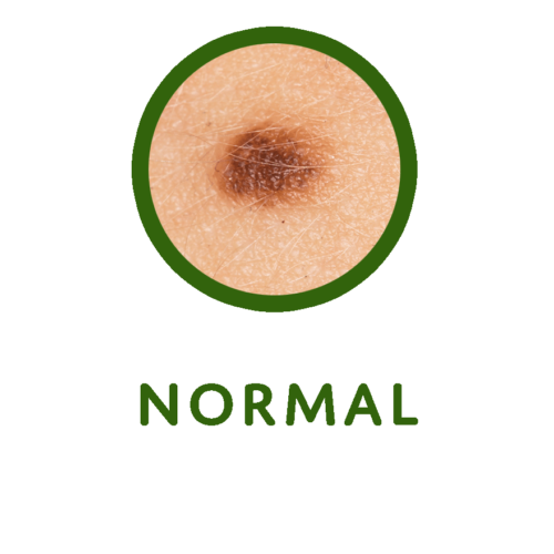 How to Check Your Moles for Skin Cancer - Prevent Cancer Foundation
